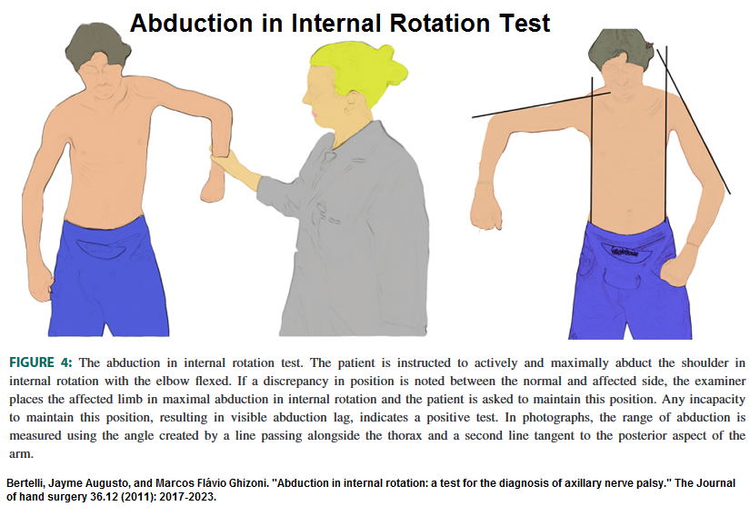 Signs of Deltoid Dysfunction From Axillary Nerve Palsy – newpainmuse